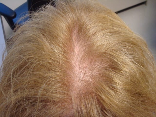 Female Pattern Hair Loss