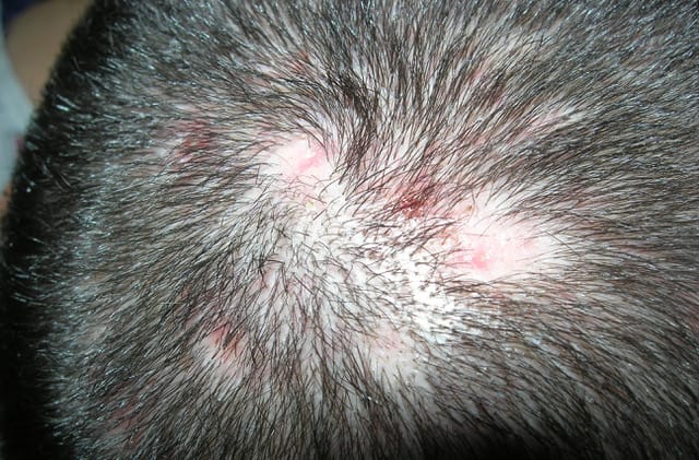 Cicatricial Alopecia